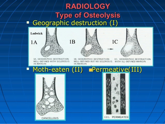 Giant cell tumors of bone