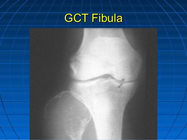 Giant cell tumors of bone