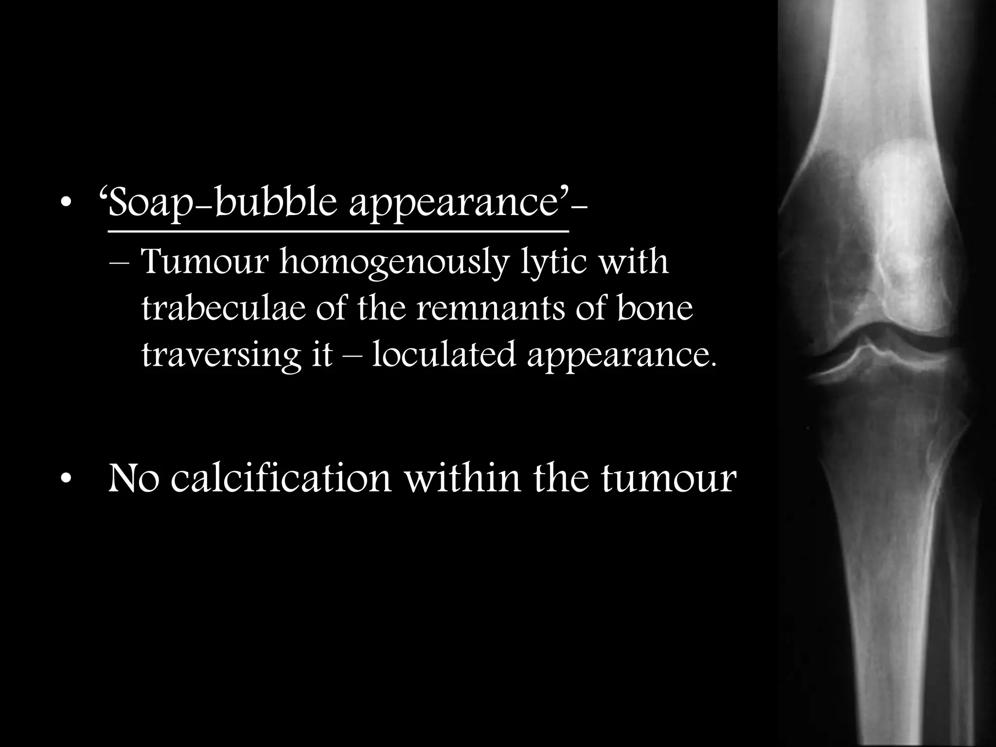 Giant cell tumour And Osteosarcoma | PPTX