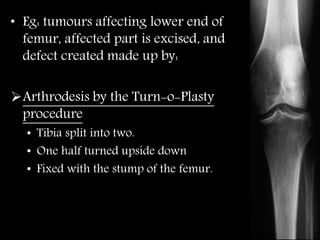 Giant cell tumour And Osteosarcoma | PPTX