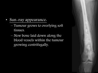 Osteosarcoma Sunray Appearance