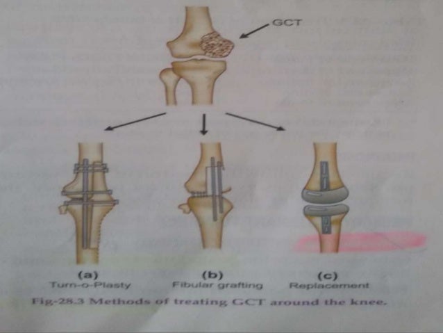 Giant cell tumour And Osteosarcoma