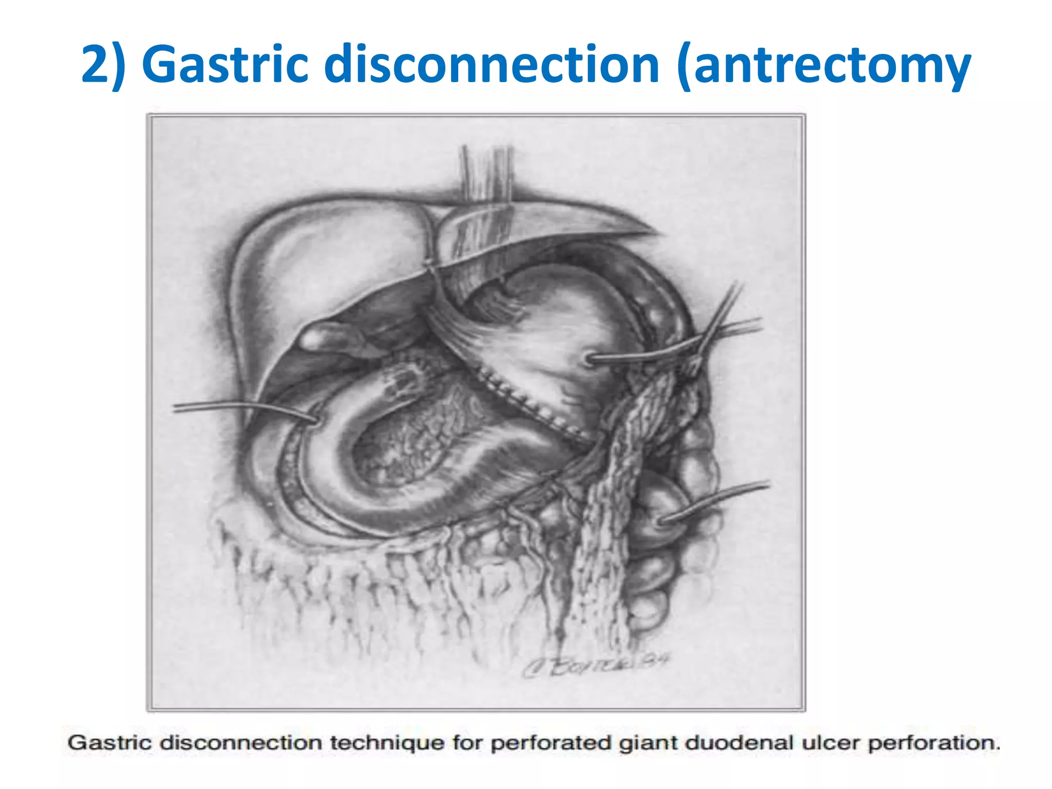 Giant Duodenal perforation Management.pptx