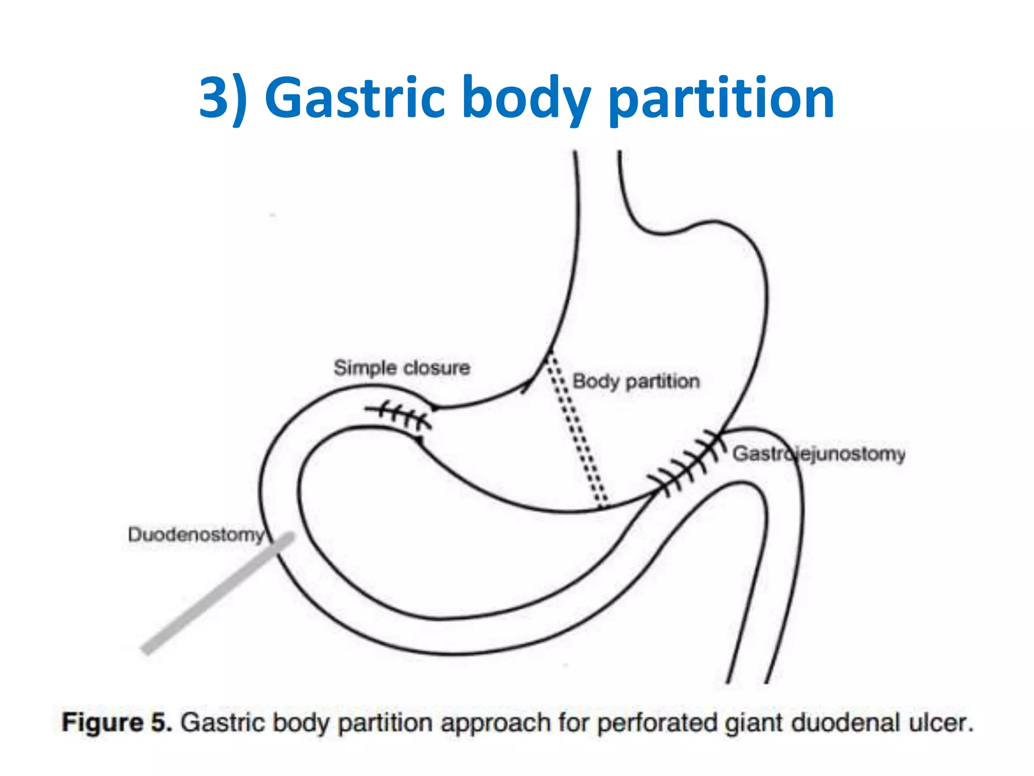 Giant Duodenal perforation Management.pptx