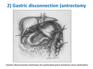 Giant Duodenal perforation Management.pptx