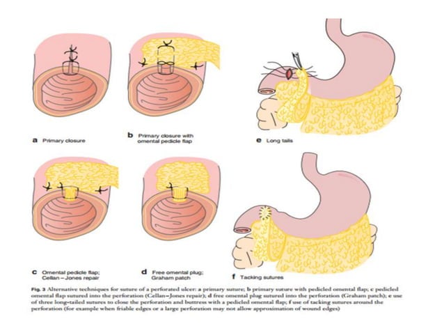 Giant Duodenal perforation Management.pptx