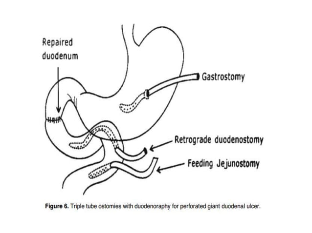 Giant Duodenal perforation Management.pptx