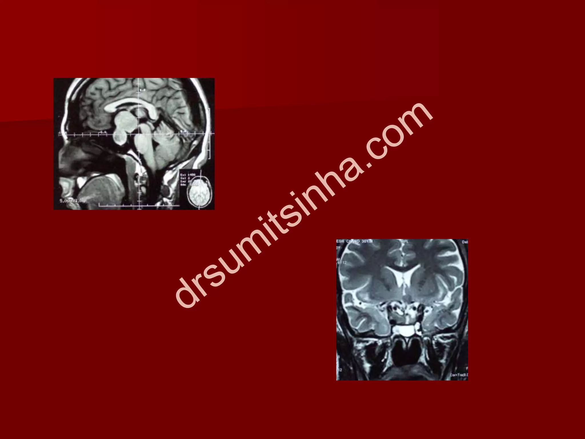 Giant pituitary adenomas.ppt | Endocrine and Metabolic Diseases ...