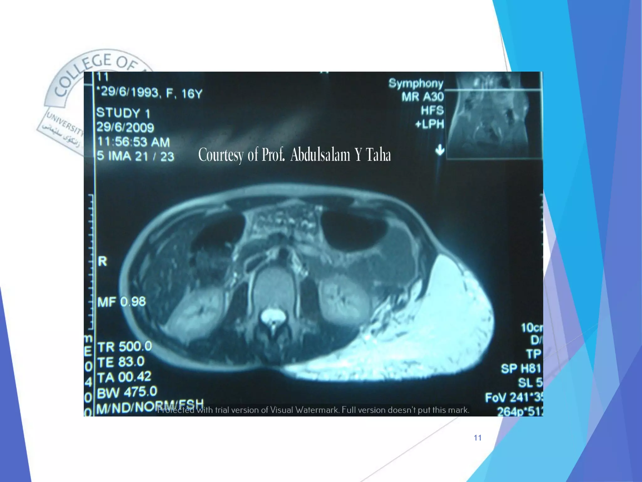 Giant Recurrent Flank Haemangioma.pdf