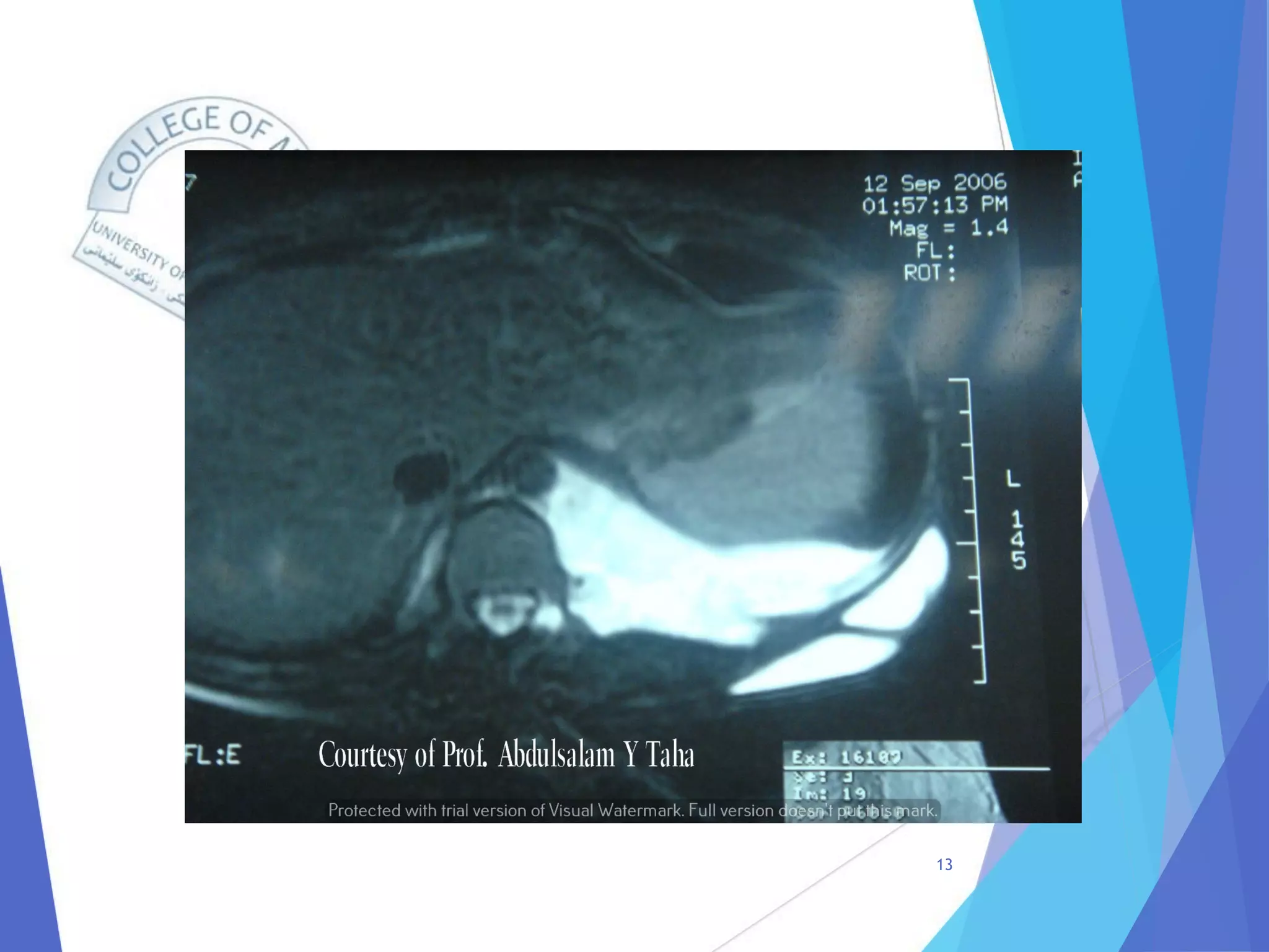 Giant Recurrent Flank Haemangioma.pdf