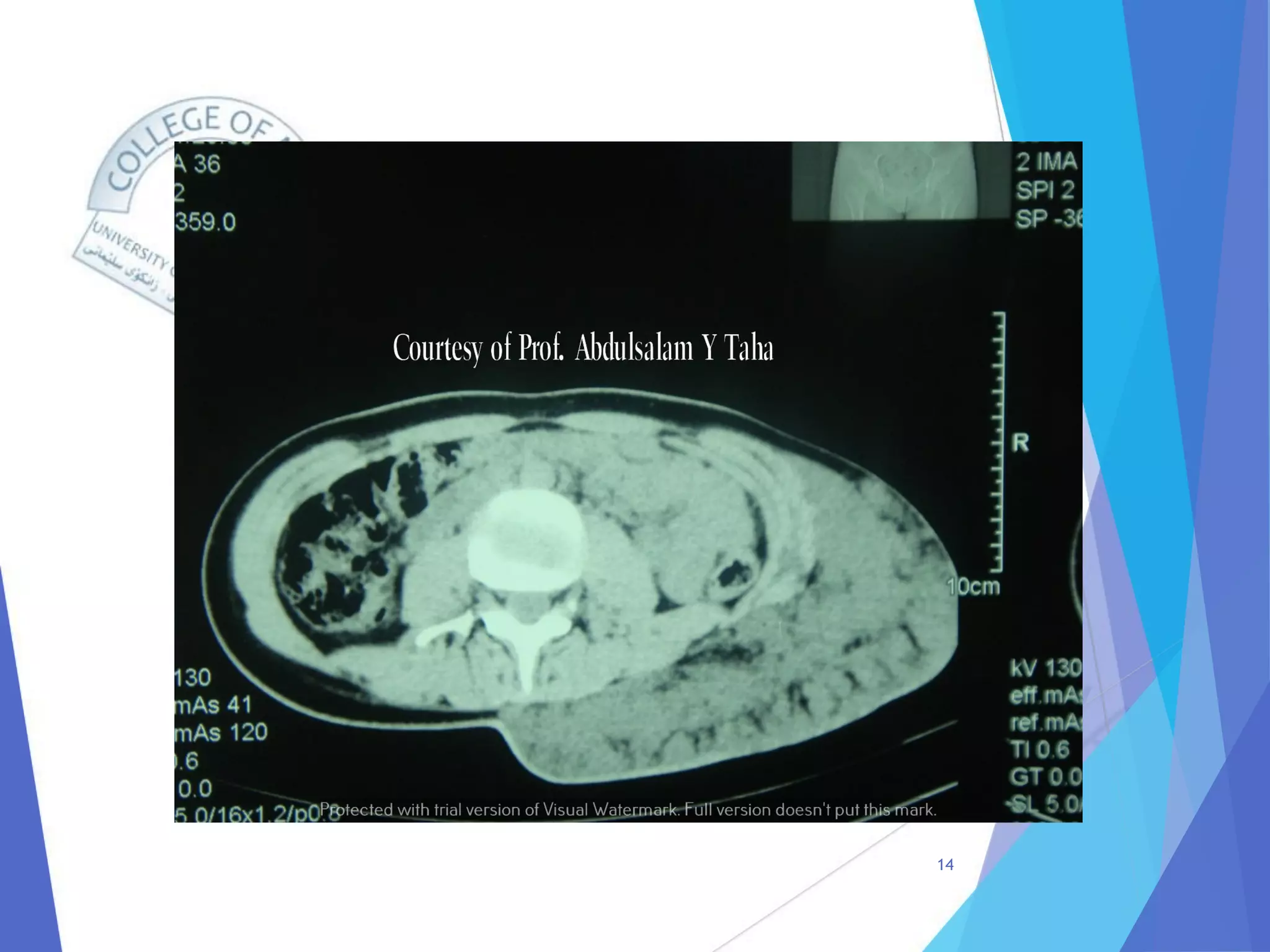 Giant Recurrent Flank Haemangioma.pdf