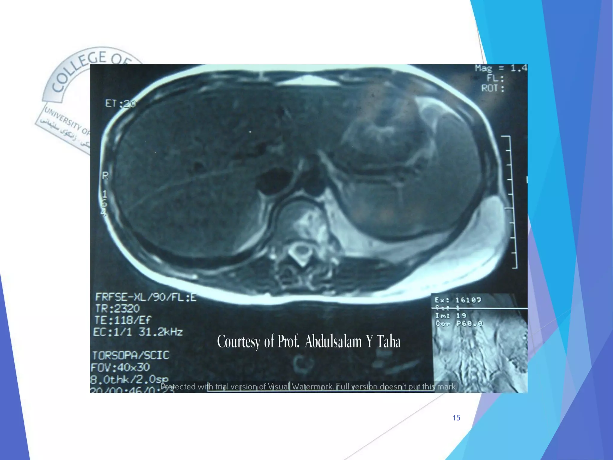Giant Recurrent Flank Haemangioma.pdf