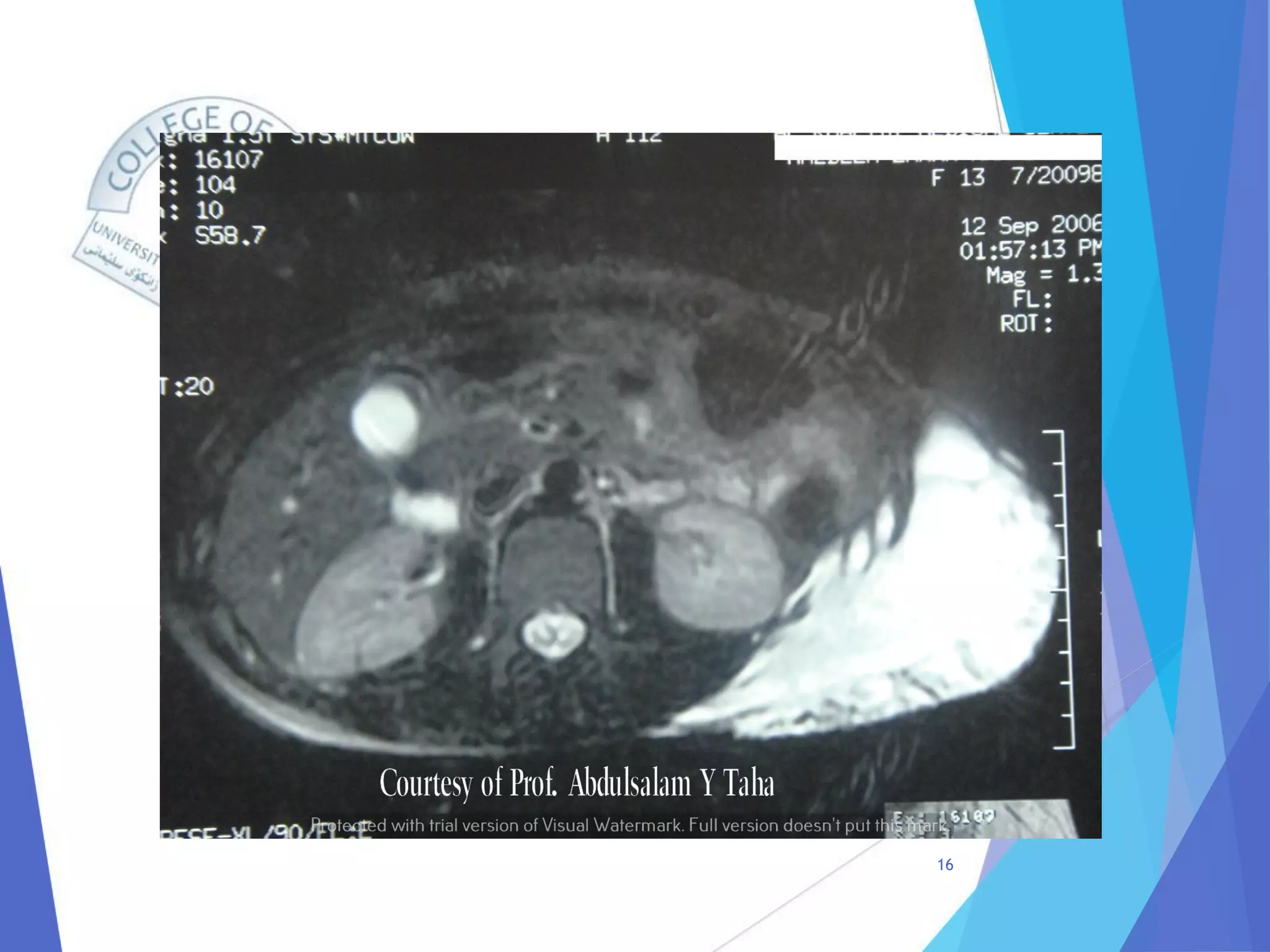 Giant Recurrent Flank Haemangioma.pdf