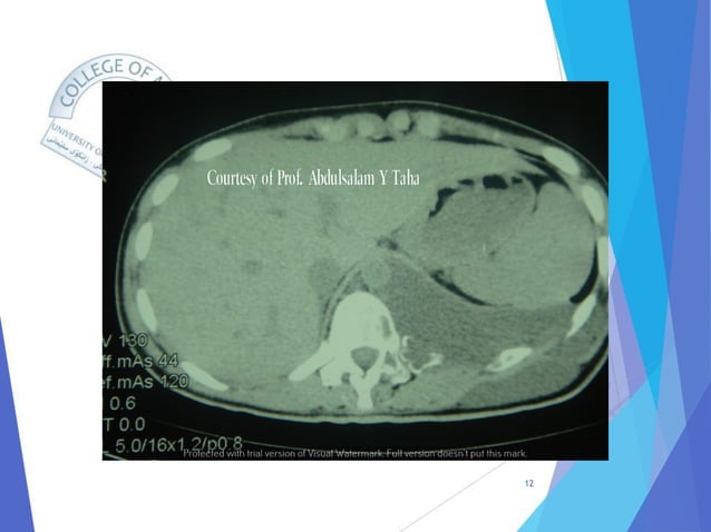 Giant Recurrent Flank Haemangioma.pdf