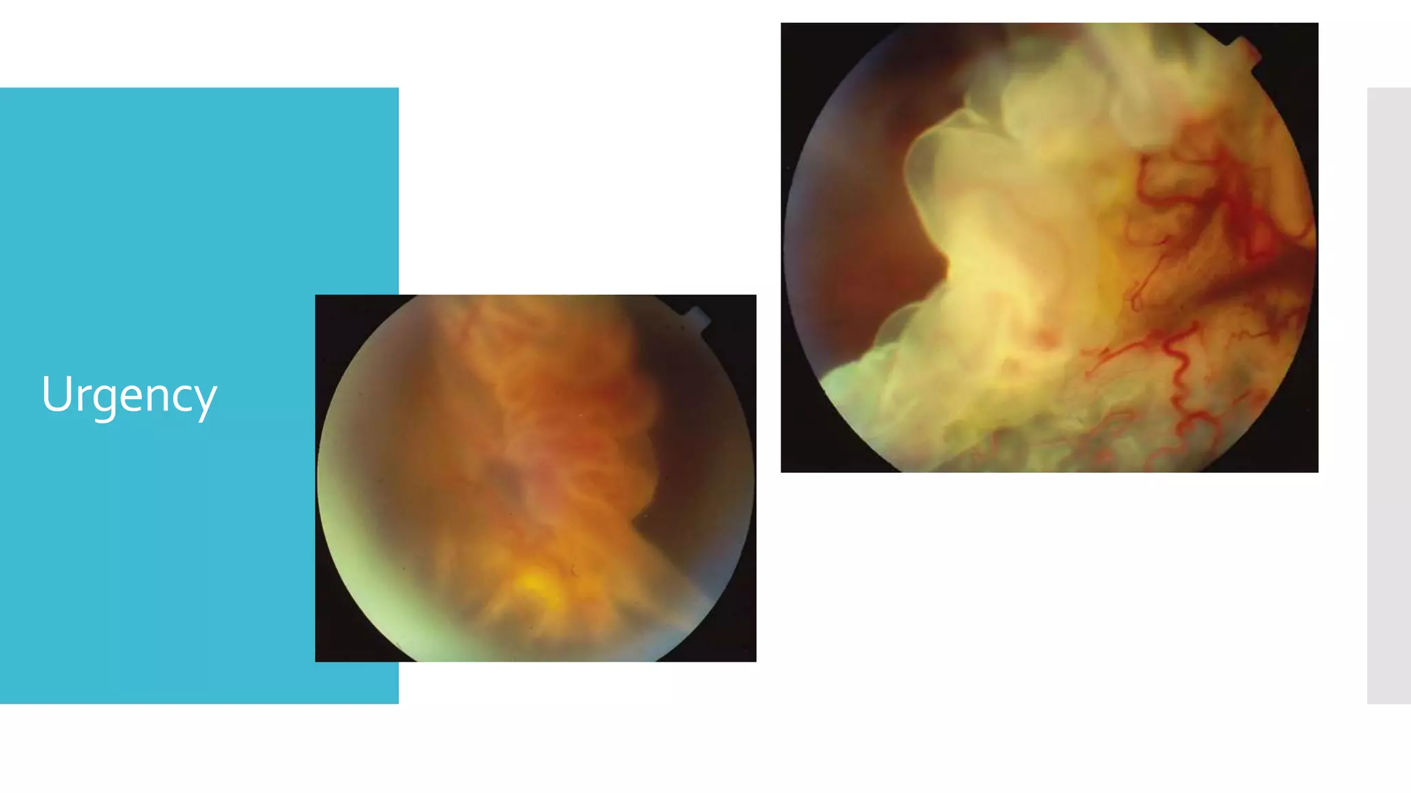 Giant retinal tear | PPTX