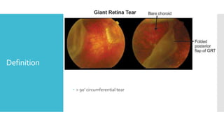 Giant retinal tear | PPTX