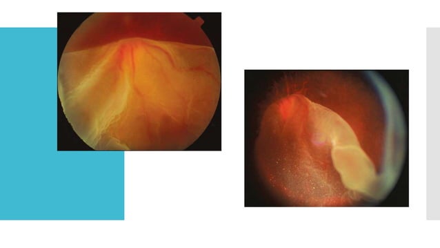 Giant retinal tear | PPTX | Eye and Vision Conditions | Diseases and ...