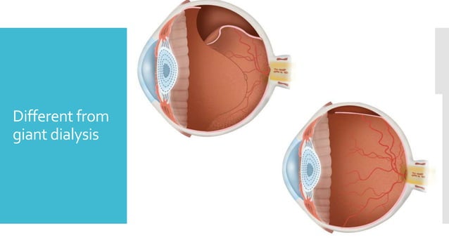 Giant retinal tear | PPTX | Eye and Vision Conditions | Diseases and ...