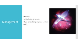 Giant retinal tear | PPTX