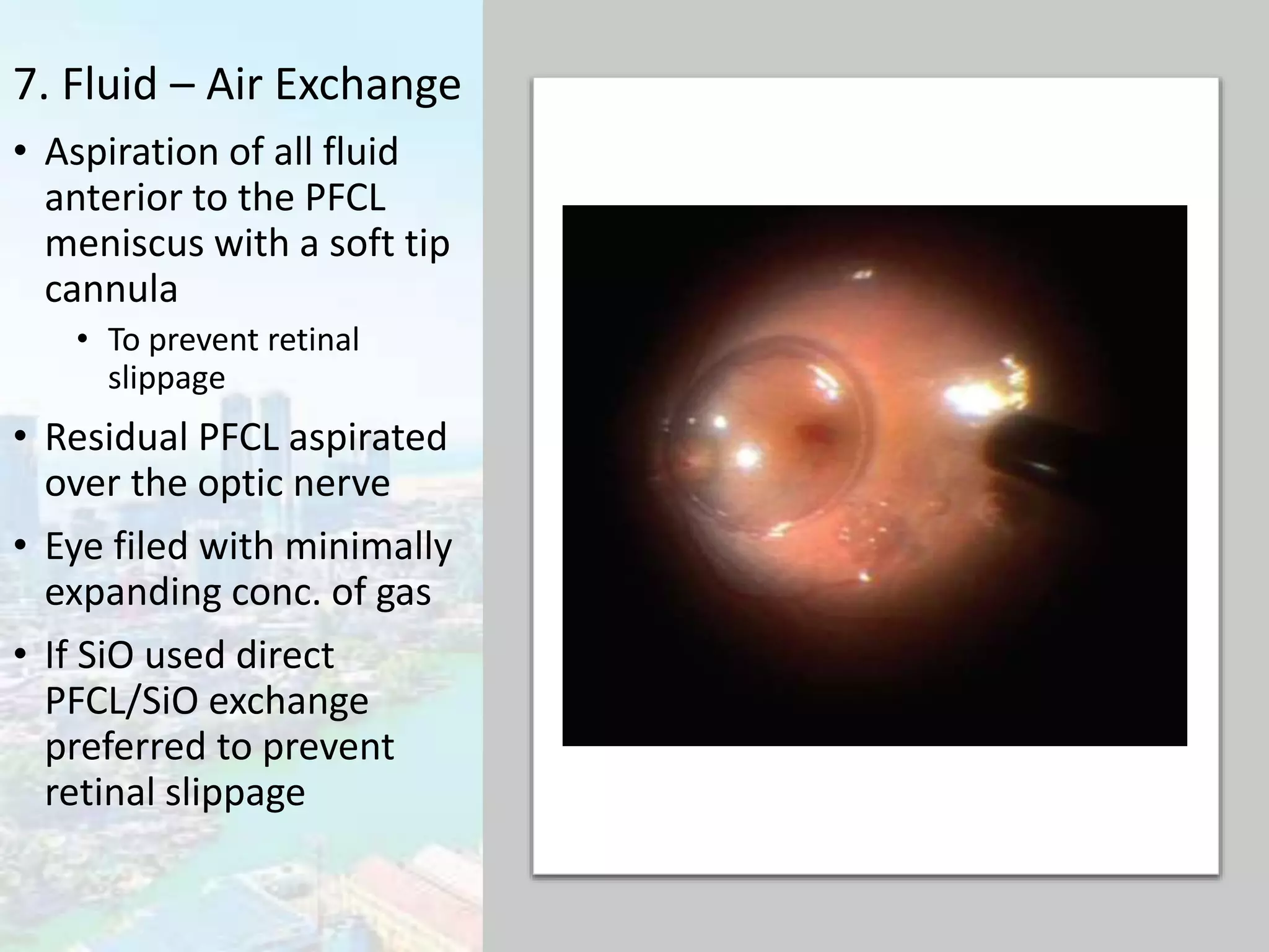 Giant Retinal Tears | PPTX