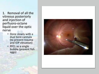 Giant Retinal Tears | PPTX