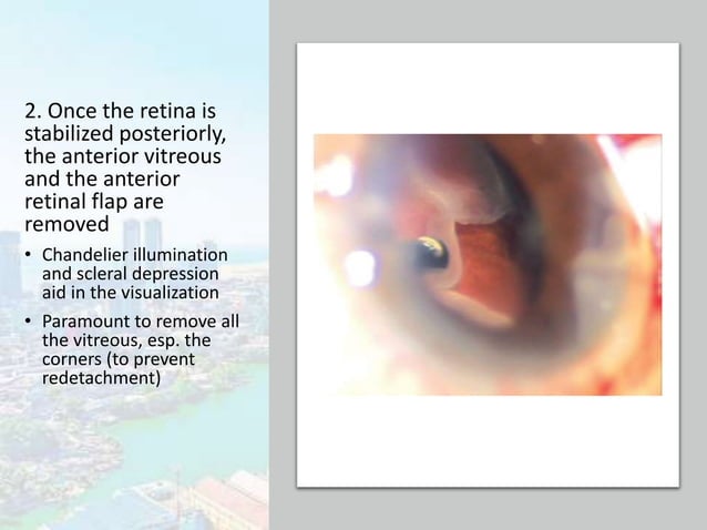 Giant Retinal Tears | PPTX