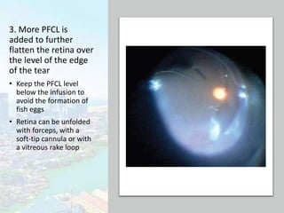 Giant Retinal Tears | PPTX