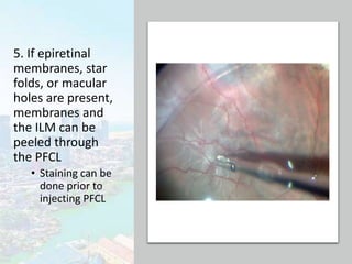 Giant Retinal Tears | PPTX