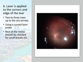 Giant Retinal Tears | PPTX