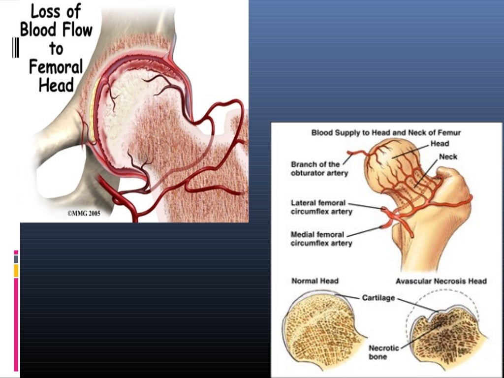 legg-calve-perthes-disease