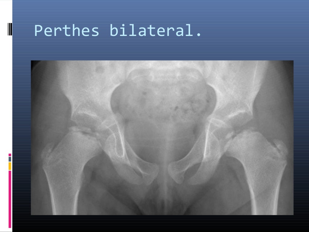 Legg- Calve – Perthes disease