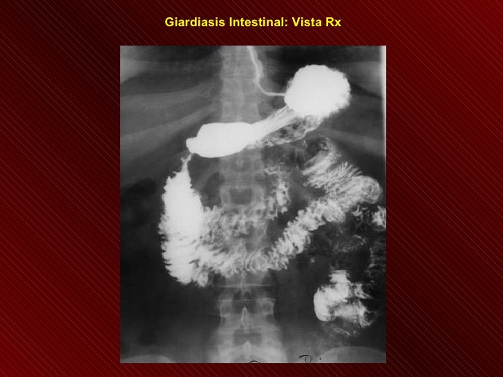 Giardiasis