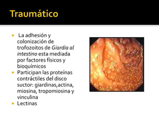 Giardiasis | PPTX