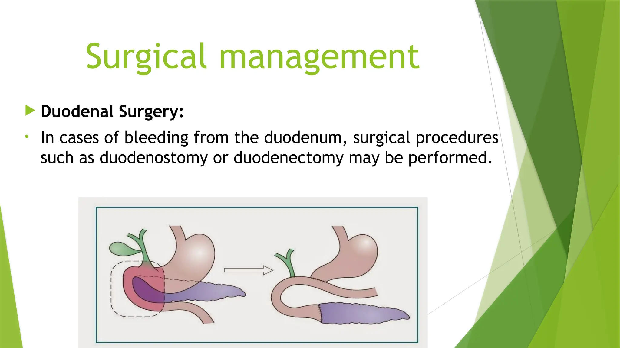GI BLEED.pptx- introduction, definition, types, causes, signs and symptoms, diagnostic ...