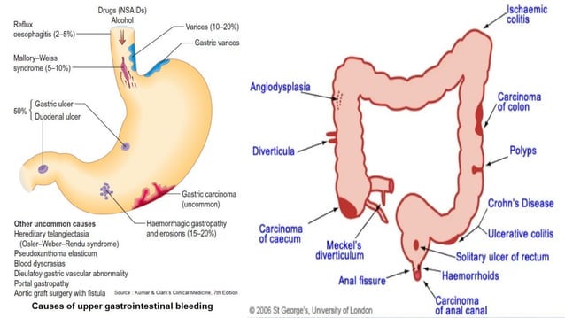 GI BLEED.pptx- introduction, definition, types, causes, signs and symptoms, diagnostic ...