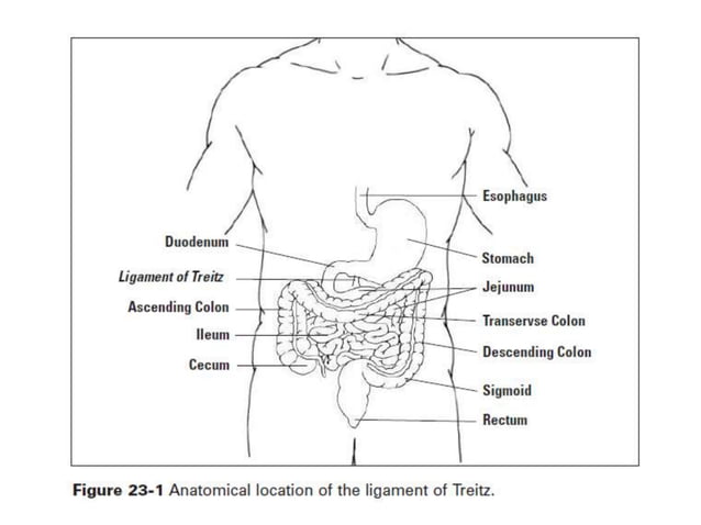GI Bleeding (Upper and Lower GIB) | PPTX | Digestive Disorders ...