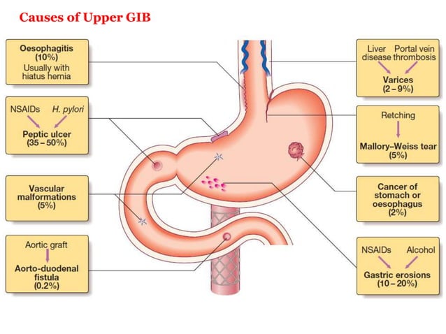 GI Bleeding (Upper and Lower GIB) | PPTX | Digestive Disorders ...