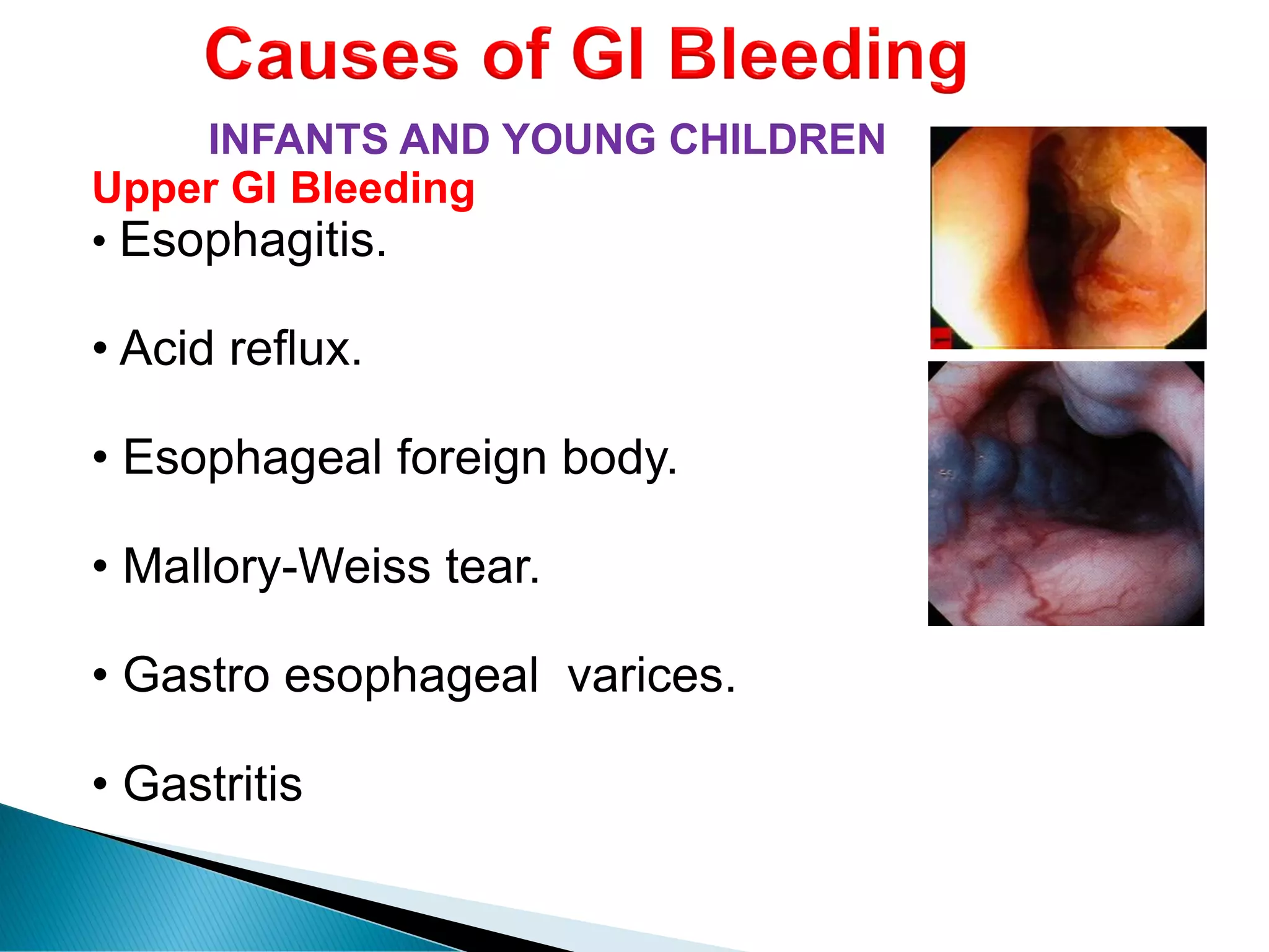 GI BLEEDING IN CHILDREN | PDF