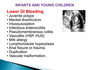 GI BLEEDING IN CHILDREN | PDF