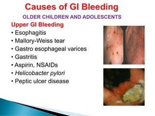 GI BLEEDING IN CHILDREN | PDF