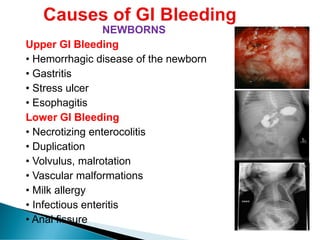 GI BLEEDING IN CHILDREN | PDF
