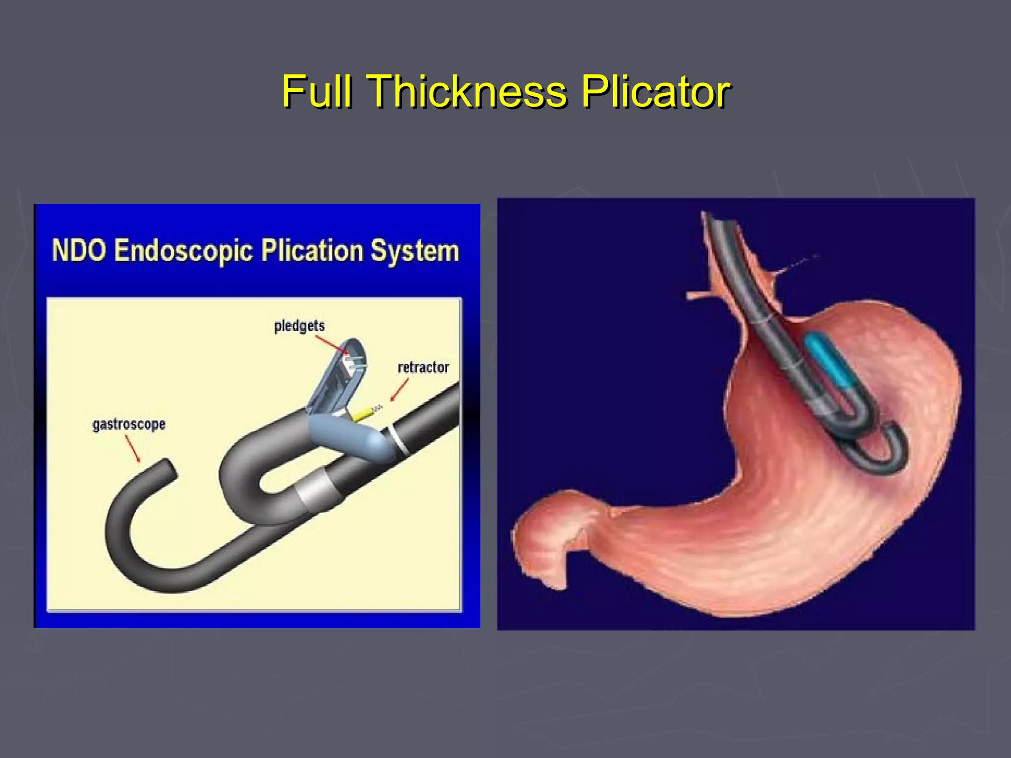 Gi diagnostic & therapeutic endoscopy | PPT