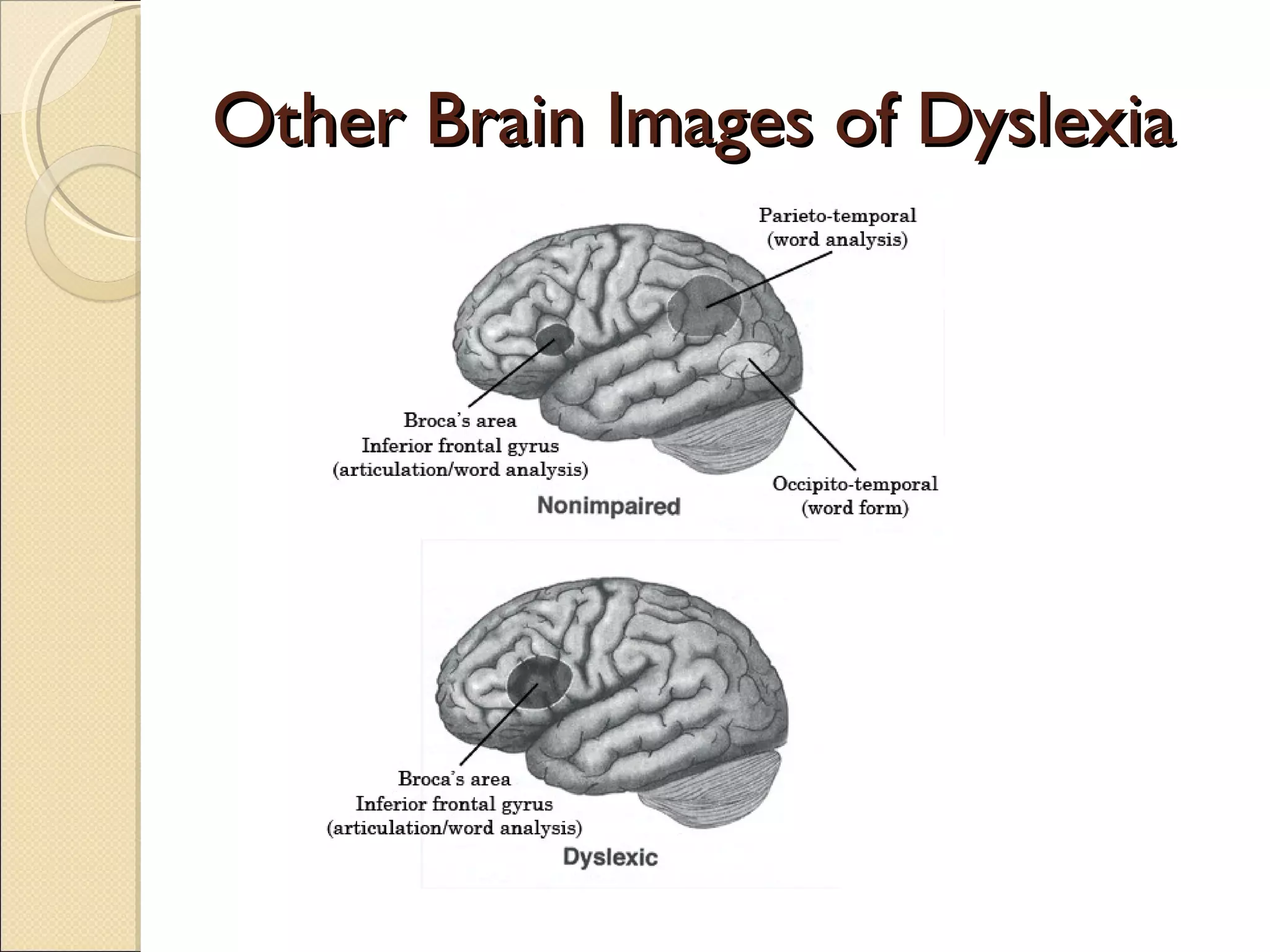 Gifted Students With Dyslexia | PPT