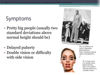 Gigantism 120223070434-phpapp01 | PPTX