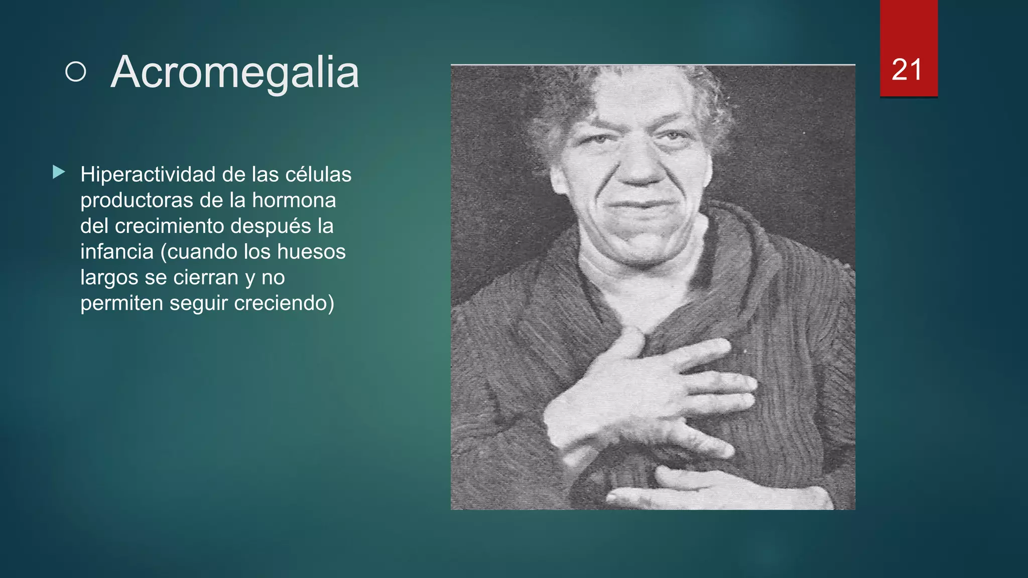 EXCESO DE HORMONAS DE CRECIMIENTO:Gigantismo-acromegalia | PDF
