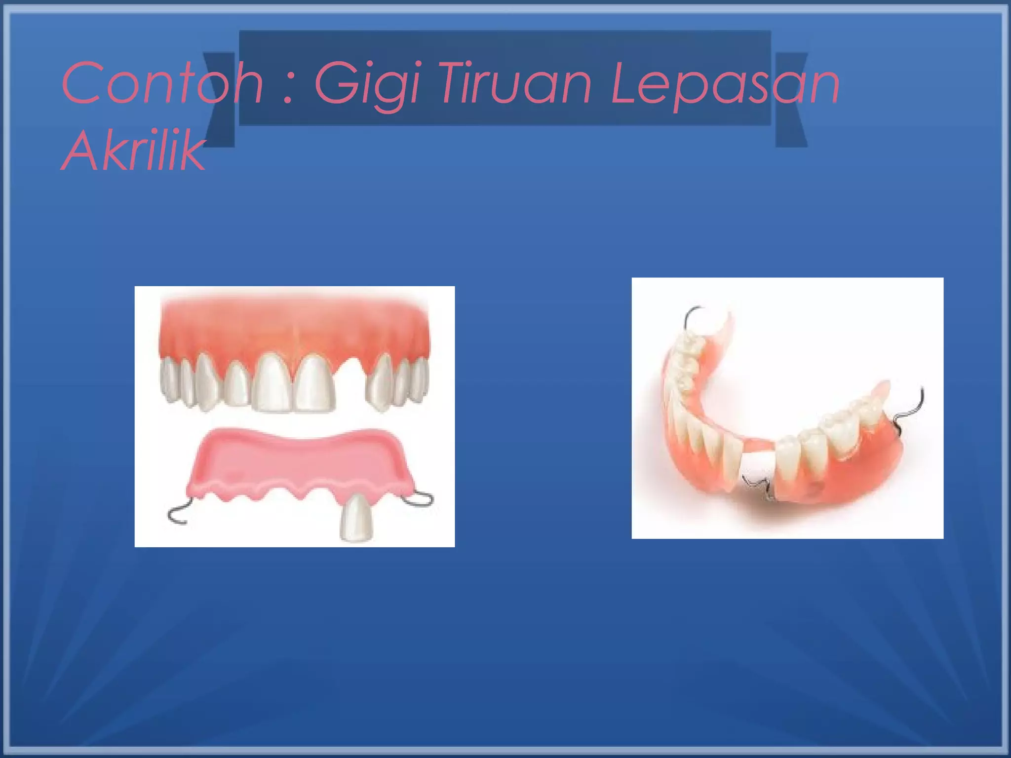 Gigi tiruan (power point) | PPT