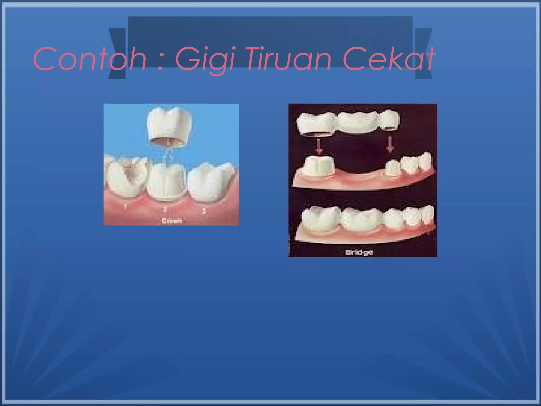 Gigi tiruan (power point) | PPT