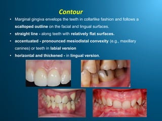 Gingiva | PPT