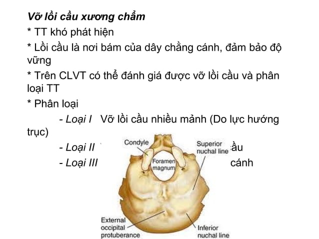 Giải phẫu cột sống và hình ảnh chấn thương cột sống trên clvt | PPT