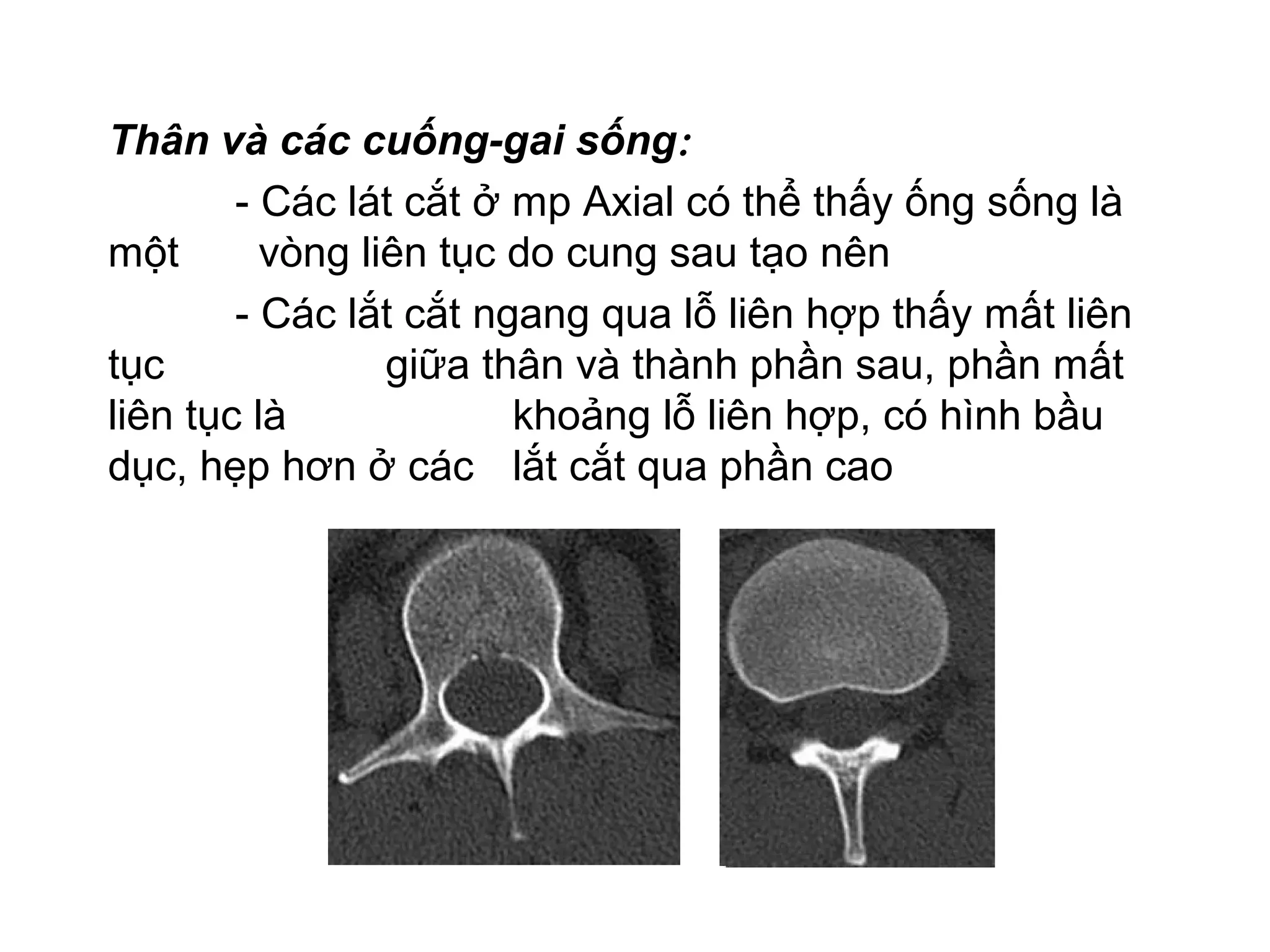Giải phẫu cột sống và hình ảnh chấn thương cột sống trên clvt | PPT
